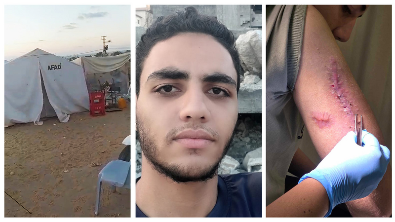 Shrapnel severed all the tendons in my right hand | The Electronic Intifada